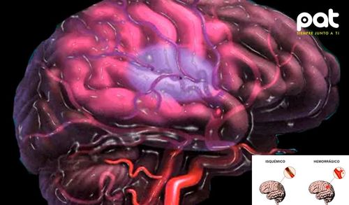 La importancia de la detección precoz del ACV: cómo reconocer los ...